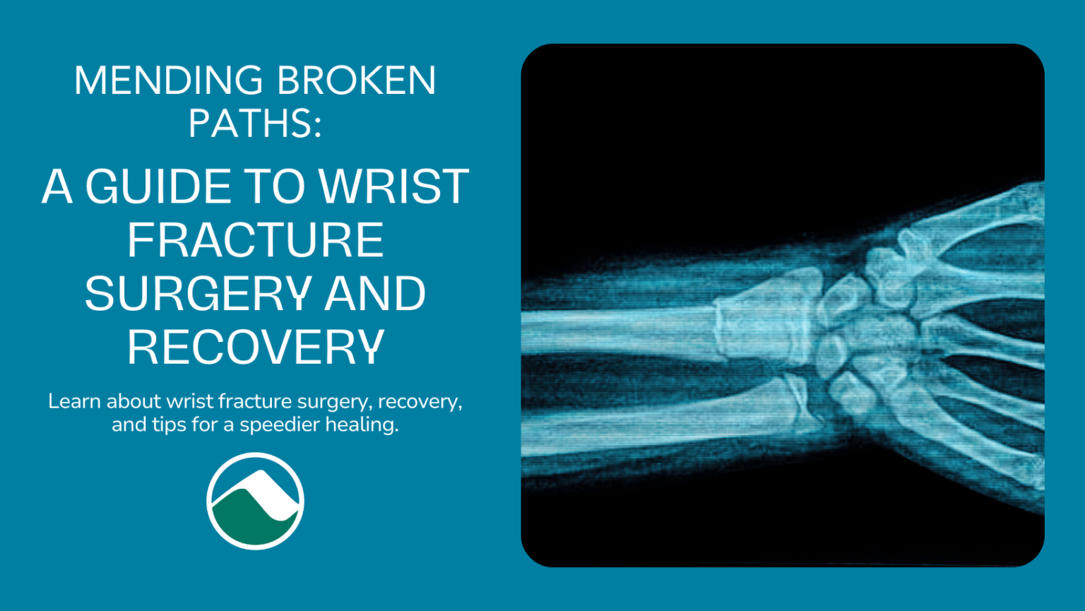 Guide to Wrist Fracture Surgery & Recovery | Monadnock Orthopaedic ...